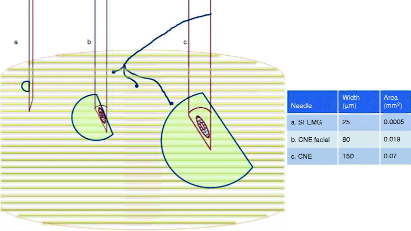 Single-Fiber EMG | SpringerLink