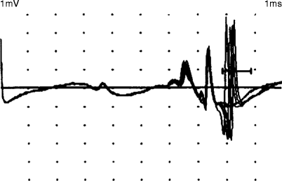 Single-Fiber EMG | SpringerLink