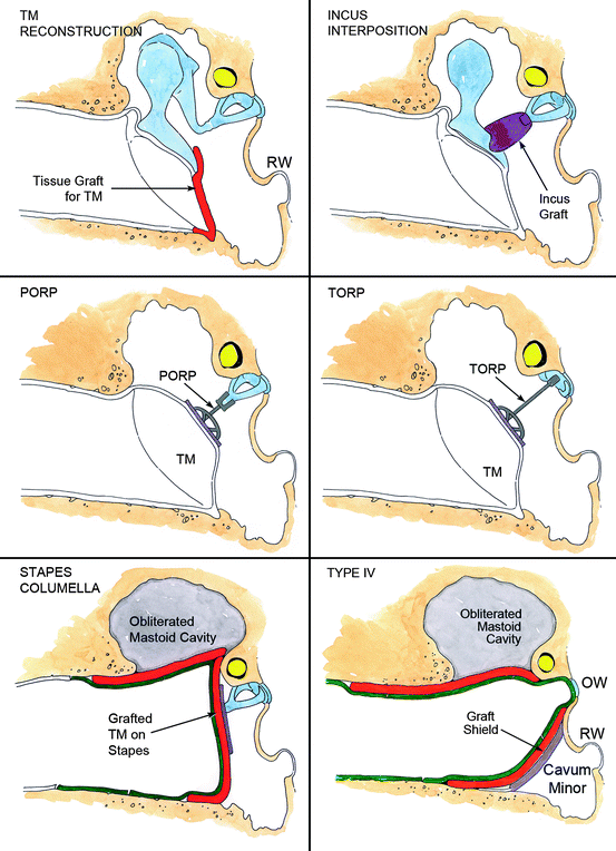 Surgical Reconstruction and Passive Prostheses | SpringerLink