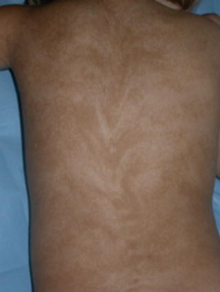 Pigmentary Mosaicism | SpringerLink