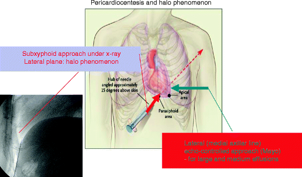 Pericardial Disease | SpringerLink