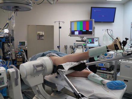 Hip Arthroscopy: Lateral Approach to Patient Positioning, Set-Up, and ...