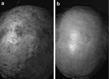 Grenz Ray Therapy | SpringerLink