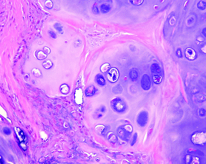 Chondroid and Osseous Tumors of Soft Tissue | SpringerLink