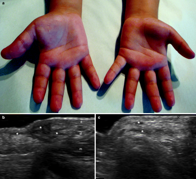 Congenital Diseases of the Skin | SpringerLink