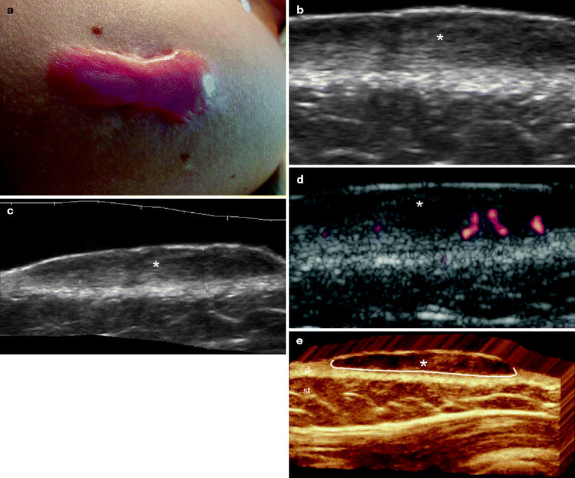 Common Benign Non-vascular Skin Tumors | SpringerLink