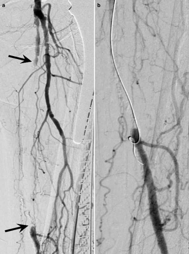 Distal Superficial Femoral Artery (SFA) Access | SpringerLink