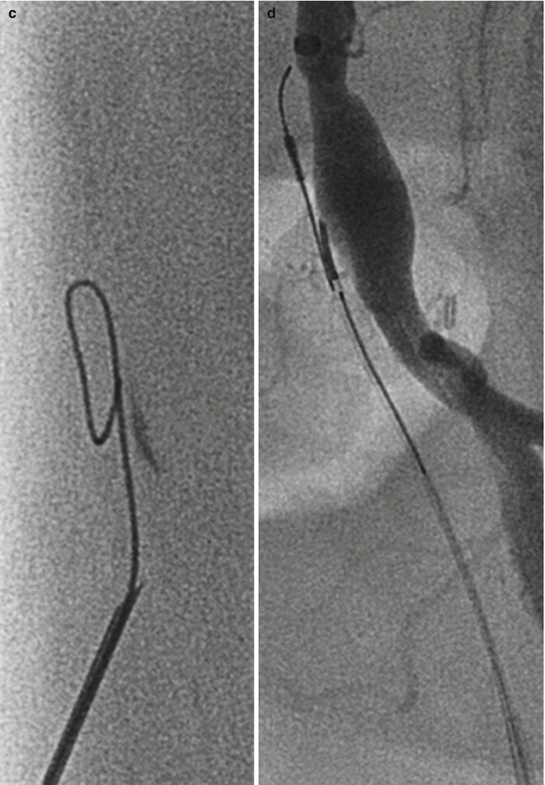 Distal Superficial Femoral Artery (SFA) Access | SpringerLink