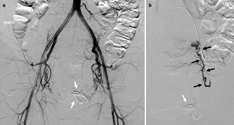 Uterine Artery Embolization | SpringerLink