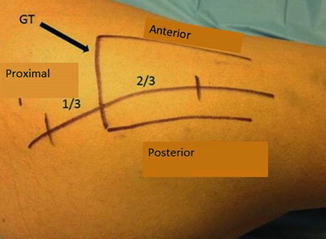 Posterolateral Approach to the Hip | SpringerLink