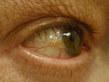 Nephrogenic Systemic Fibrosis | SpringerLink