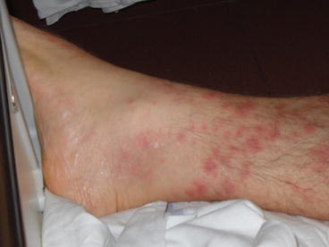 Skin Manifestations in Microscopic Polyangiitis | SpringerLink