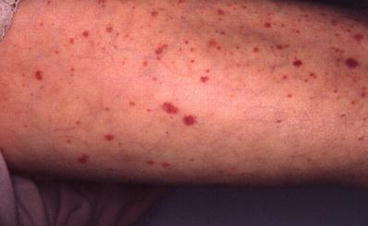 Skin Manifestations and Cryoglobulinemia | SpringerLink
