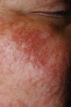 Telangiectasias | SpringerLink