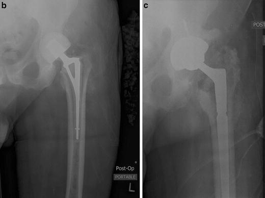 Two-Stage Exchange Hip Arthroplasty: Articulating Spacers | SpringerLink