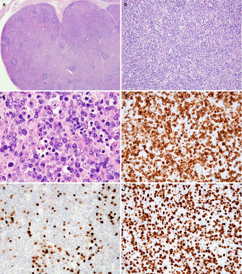 Systemic Lupus Erythematosus Lymphadenopathy | SpringerLink