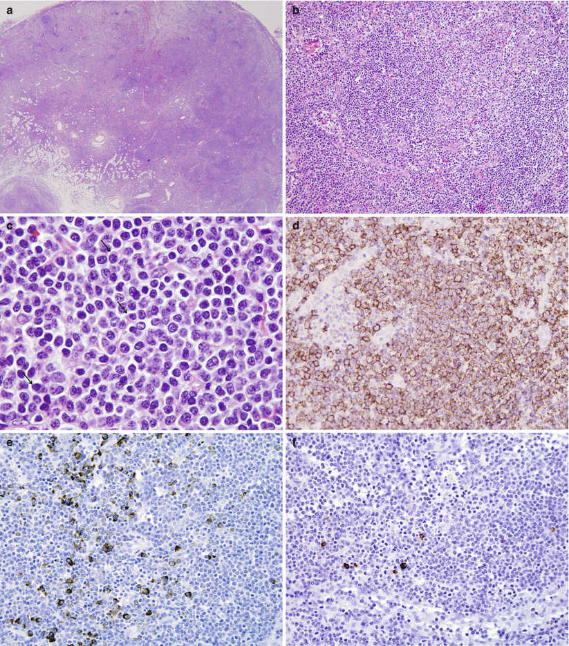 Lymphoplasmacytic Lymphoma and Waldenstrom Macroglobulinemia | SpringerLink
