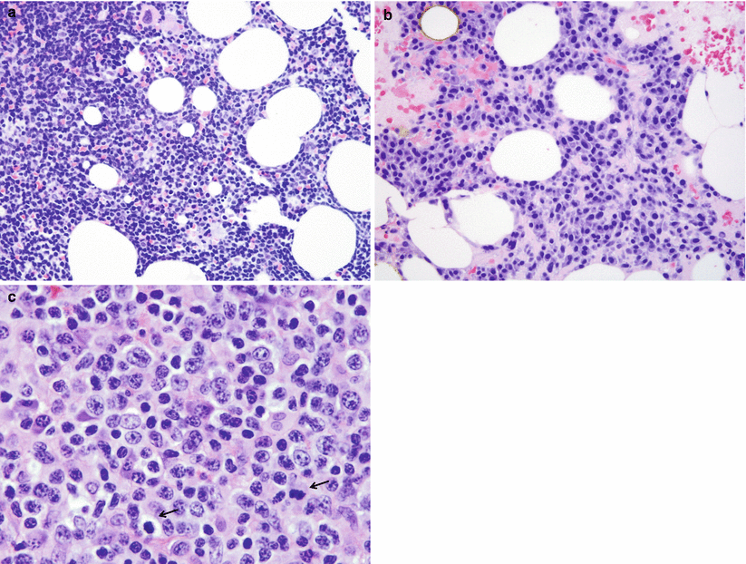 Lymphoplasmacytic Lymphoma and Waldenstrom Macroglobulinemia | SpringerLink