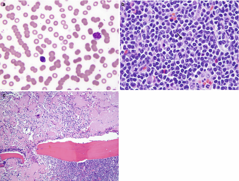 Lymphoplasmacytic Lymphoma and Waldenstrom Macroglobulinemia | SpringerLink