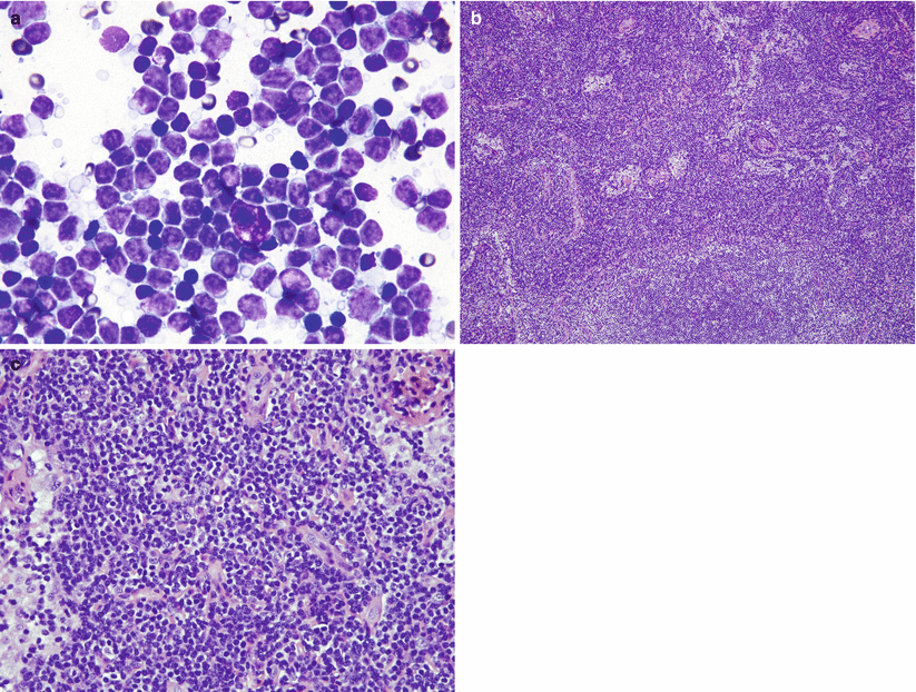 Lymphoplasmacytic Lymphoma and Waldenstrom Macroglobulinemia | SpringerLink