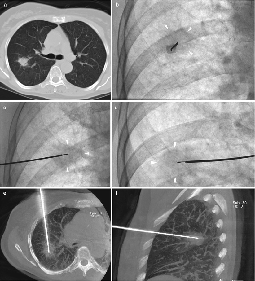 Fluoroscopy-Guided Biopsy | SpringerLink