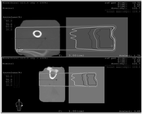 Radiation Therapy Dosimetry Phantoms | SpringerLink