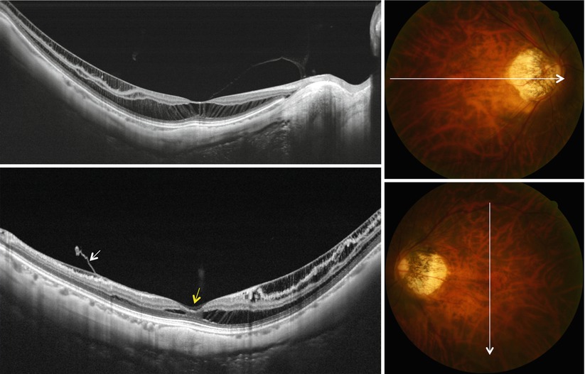 Vitreous Changes in Myopia | SpringerLink