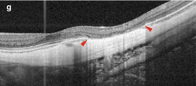 Myopic Chorioretinal Atrophy | SpringerLink