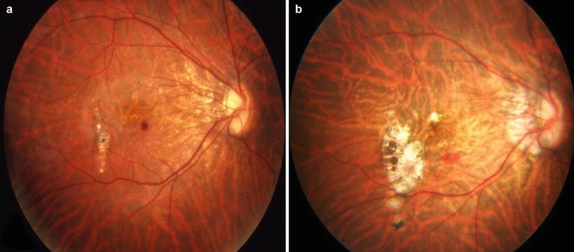 Myopic Chorioretinal Atrophy | SpringerLink