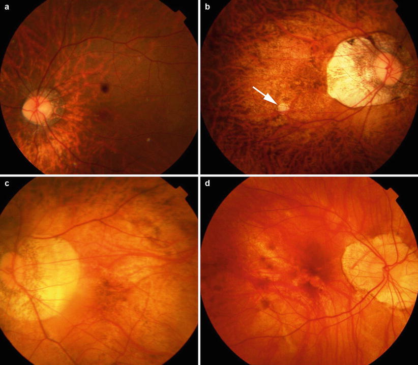 Myopic Chorioretinal Atrophy | SpringerLink