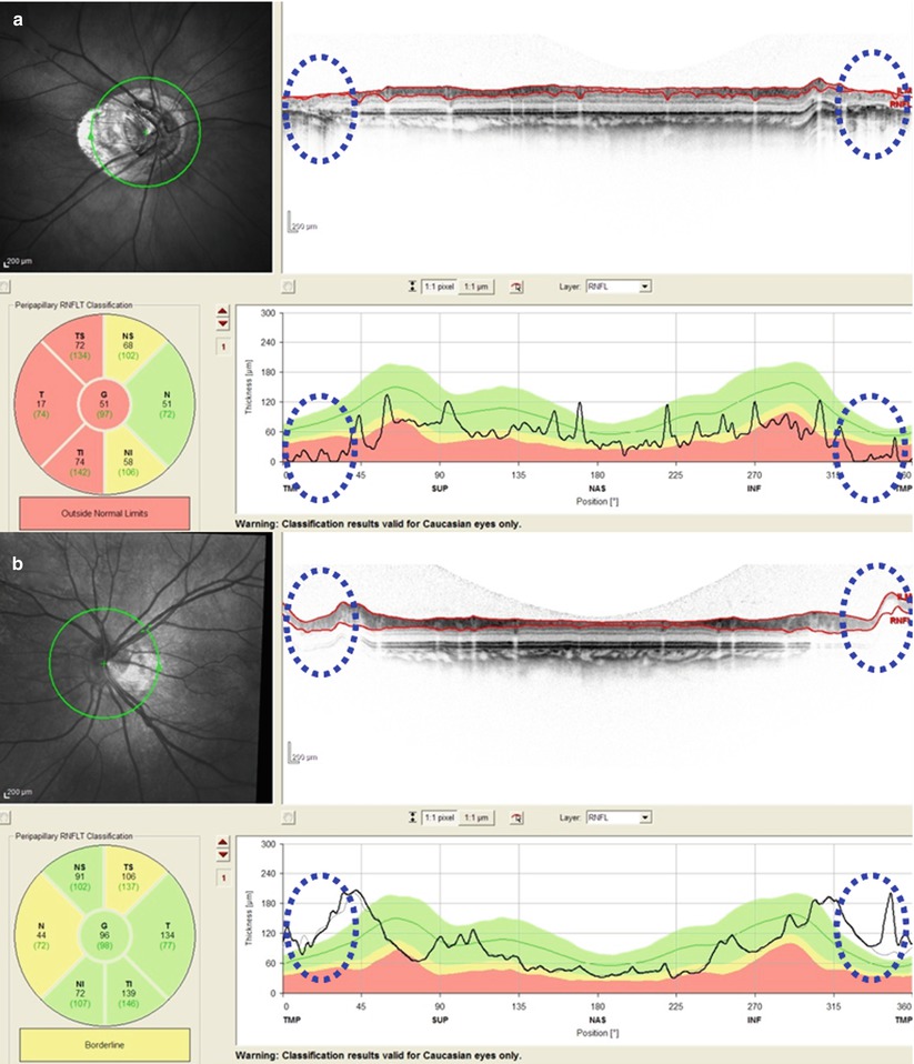 Glaucoma in Myopia | SpringerLink