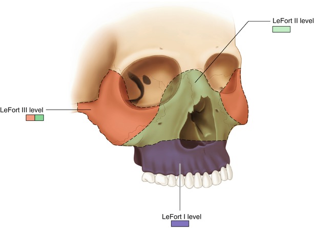 Midfacial Fractures | SpringerLink