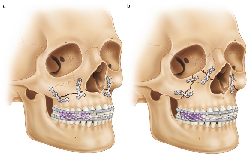 Midfacial Fractures | SpringerLink