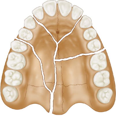 Midfacial Fractures | SpringerLink