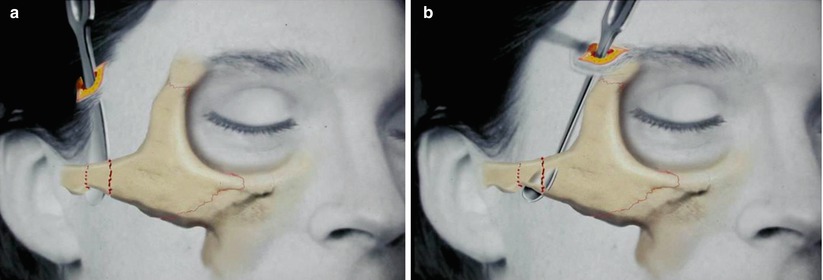 Zygoma Fractures | SpringerLink