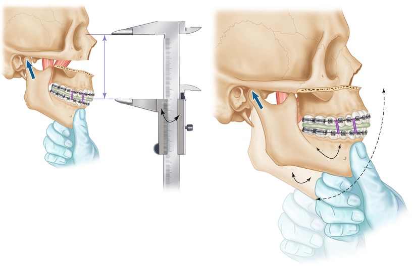 Maxillary Osteotomies | SpringerLink