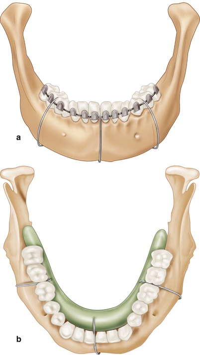 Impressions, Models, and Splints: The Basic Maxillofacial Laboratory ...