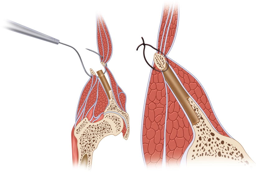 Bone Grafting: Physiology and Techniques | SpringerLink