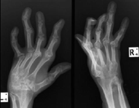 PAPA Syndrome | SpringerLink