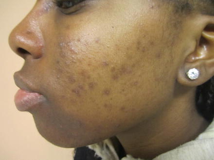 Post-inflammatory Pigment Alteration | SpringerLink