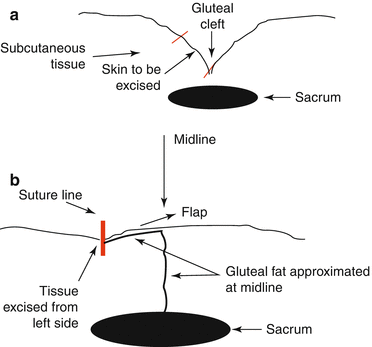 Pilonidal Disease and Hidradenitis Suppurativa | SpringerLink