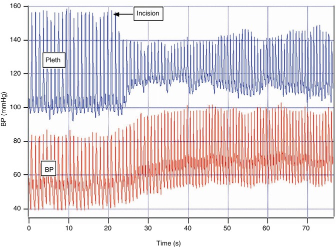 Photoplethysmography: Analysis of the Pulse Oximeter Waveform ...