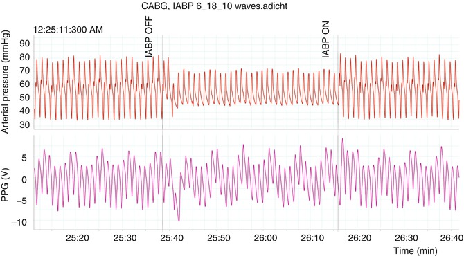 Photoplethysmography: Analysis of the Pulse Oximeter Waveform ...