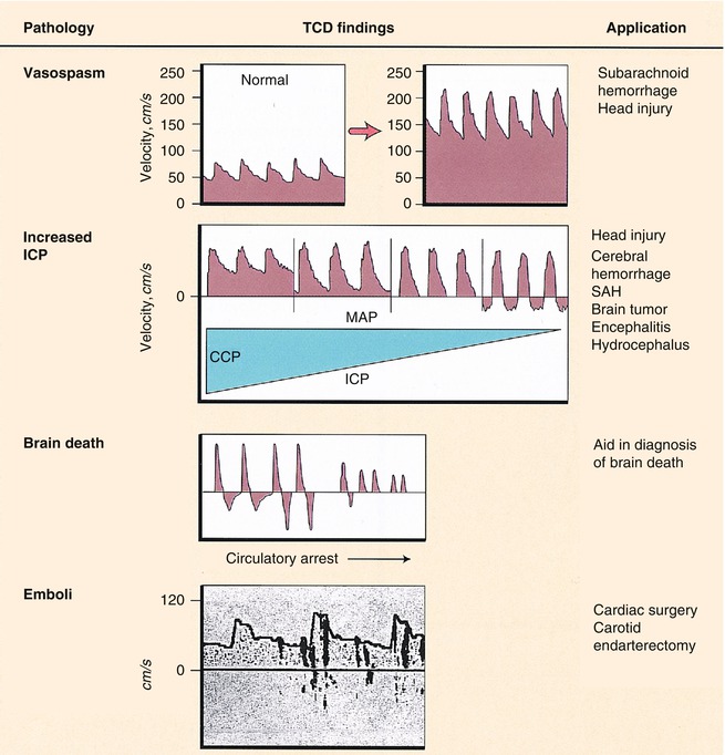 Transcranial Doppler | SpringerLink