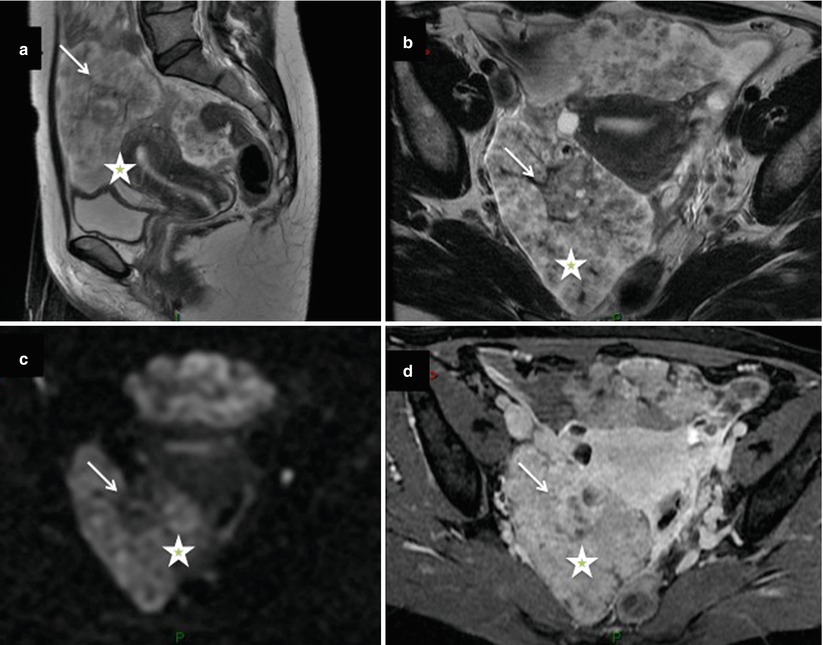 CT and MR Imaging of Ovarian Adenocarcinoma (Serous/Mucinous ...