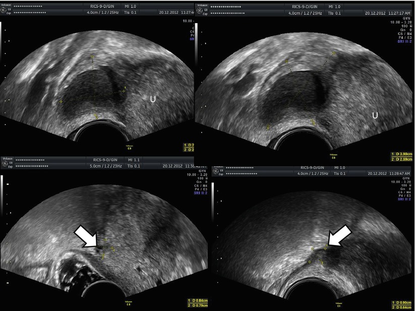 The Ovarian Endometrioma: Clinical Setting and Ultrasound Findings ...
