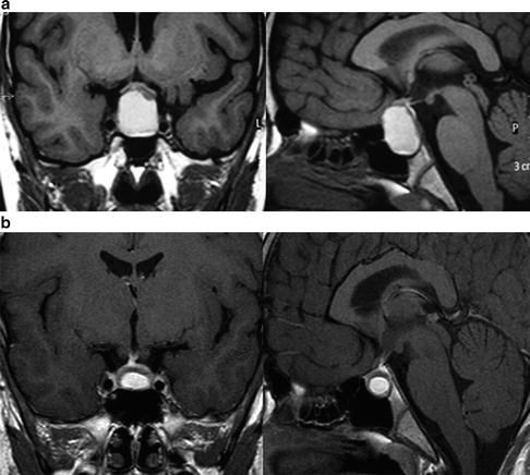 Hyperprolactinemia | SpringerLink