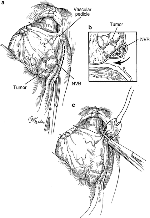 Open Salvage Radical Prostatectomy for Recurrence of Prostate Cancer ...