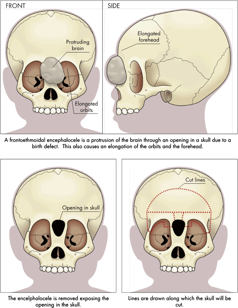 Encephaloceles | SpringerLink