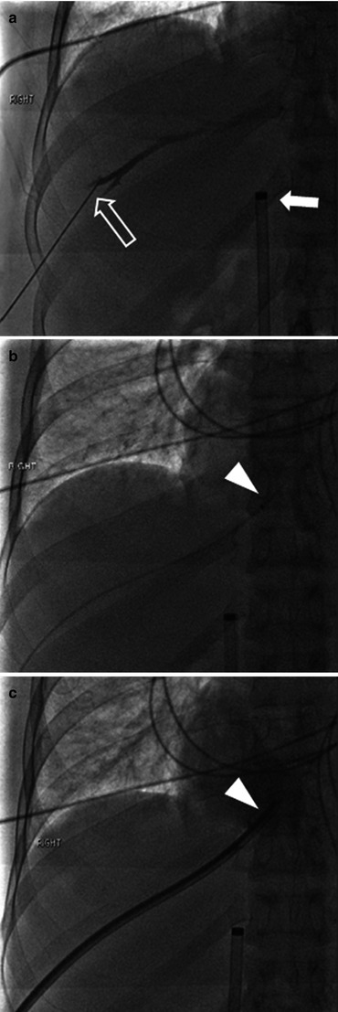 Unconventional Venous Access: Percutaneous Translumbar and Transhepatic ...